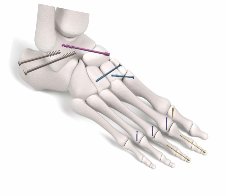 Compression Bone Screws | Trax Surgical