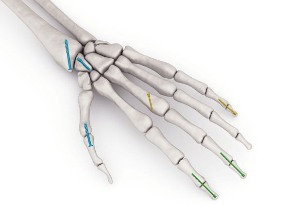 Compression Bone Screws | Trax Surgical